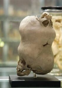 Bengal Two-Headed Boy: The Tragic Life of a Parasitic Twin